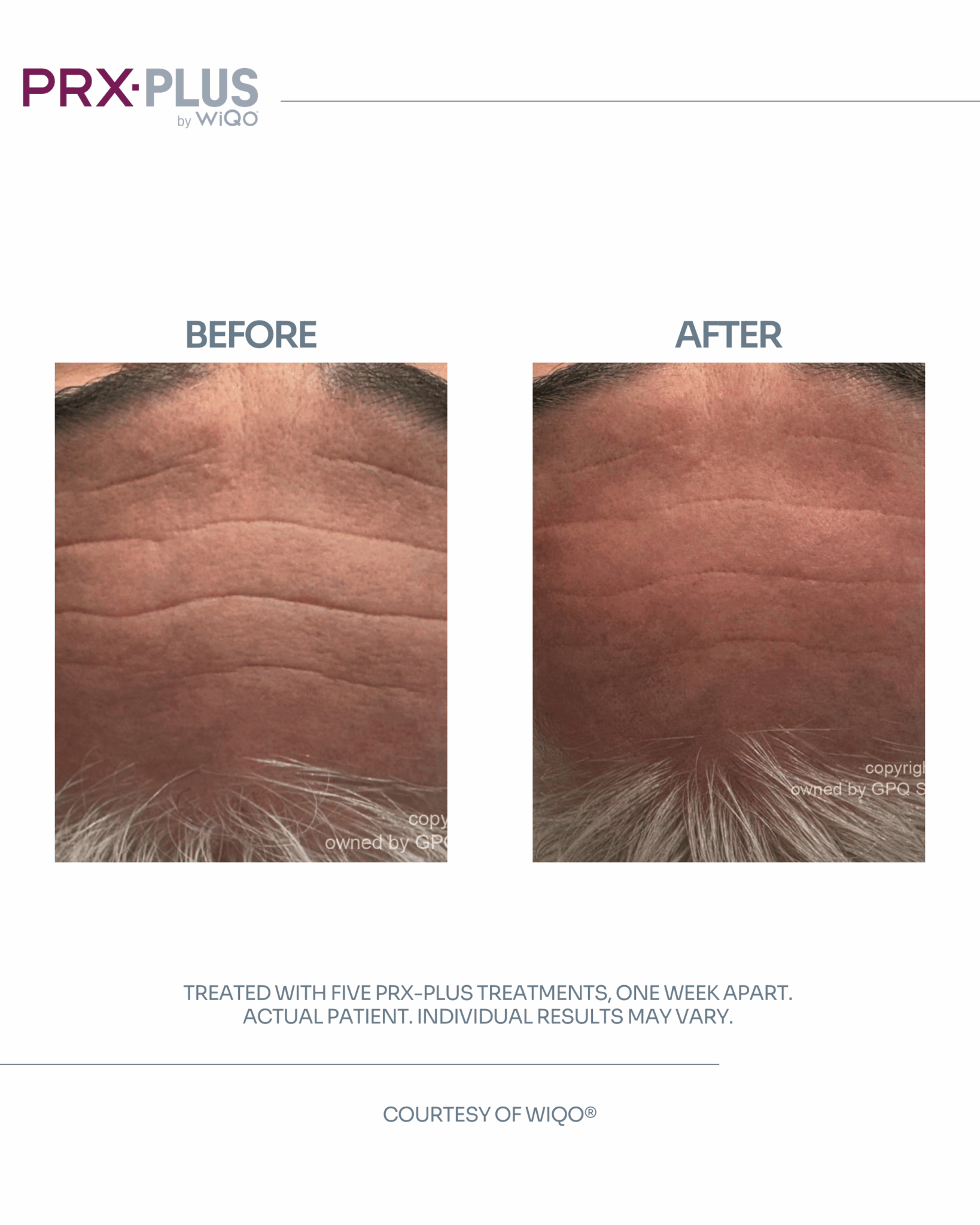 PRX Collagen Biostimulator | Skin Rejuvenation | Wellington